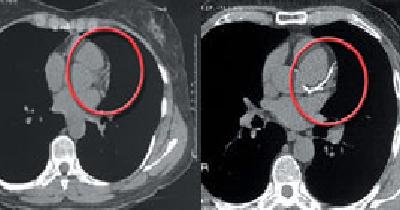 The Ebt Heart Scan - Body Scan